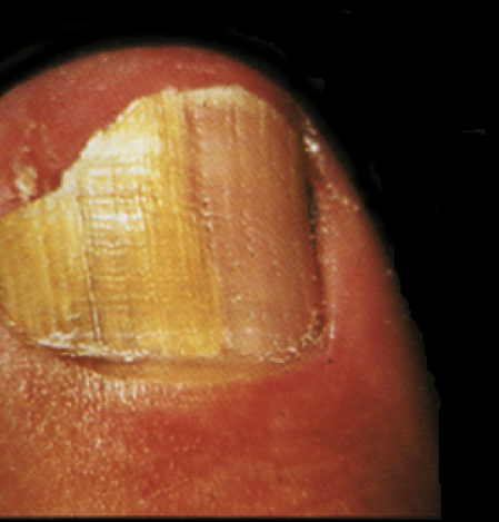 Fungal Nails | CHORLEY: 07849 890912 / 01257 263173 HORWICH: 07545 181857
